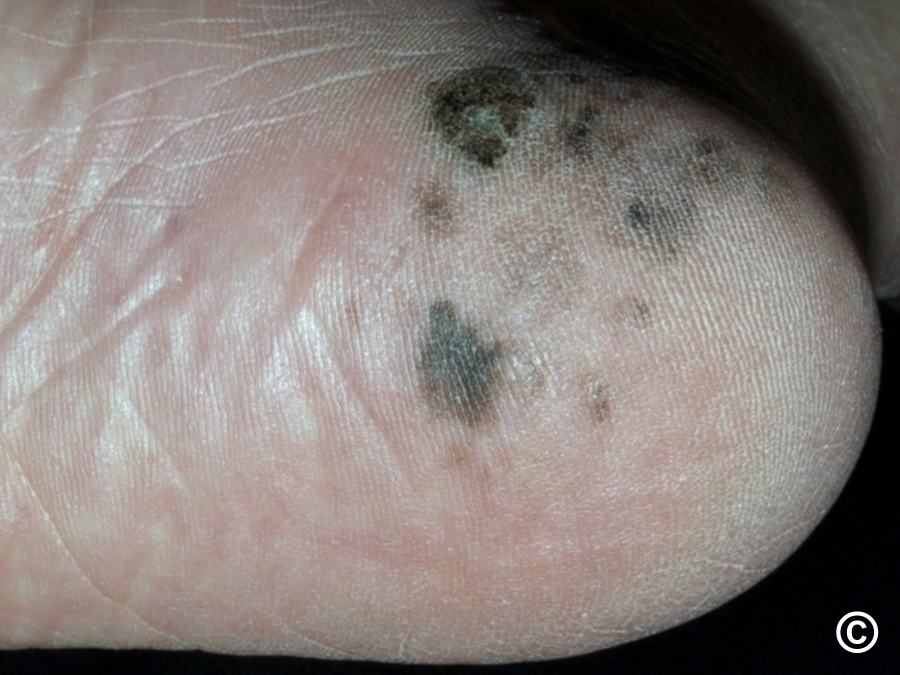 Acral-lentiginous melanoma