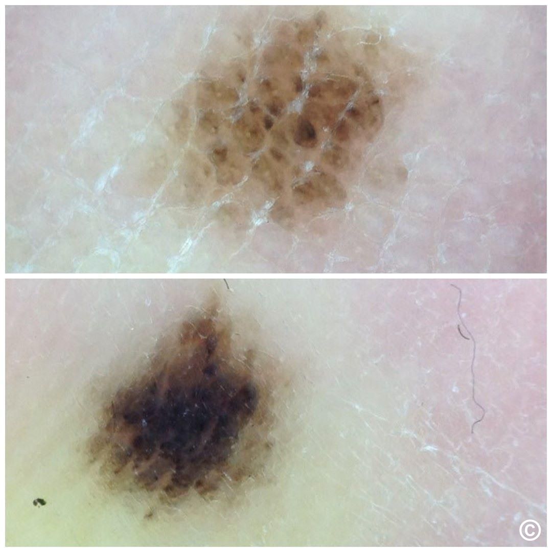 Acral-lentiginous melanoma