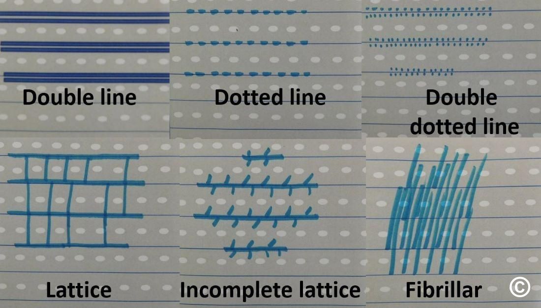 Acral-lentiginous melanoma