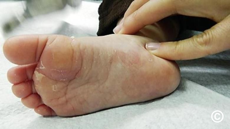 Acral Peeling Skin syndrome