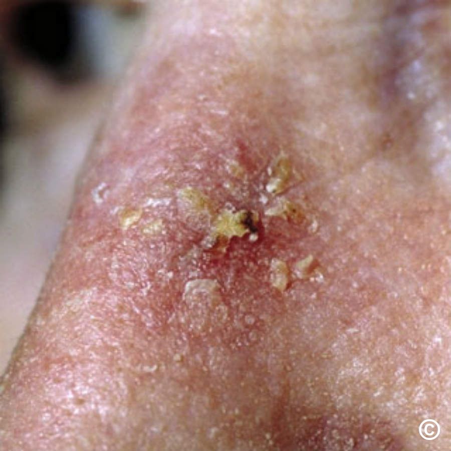 Actinic Keratosis With Severe Dysplasia Actinic Cheilitis: Pictures,