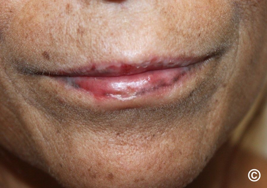 Addisons Disease Face