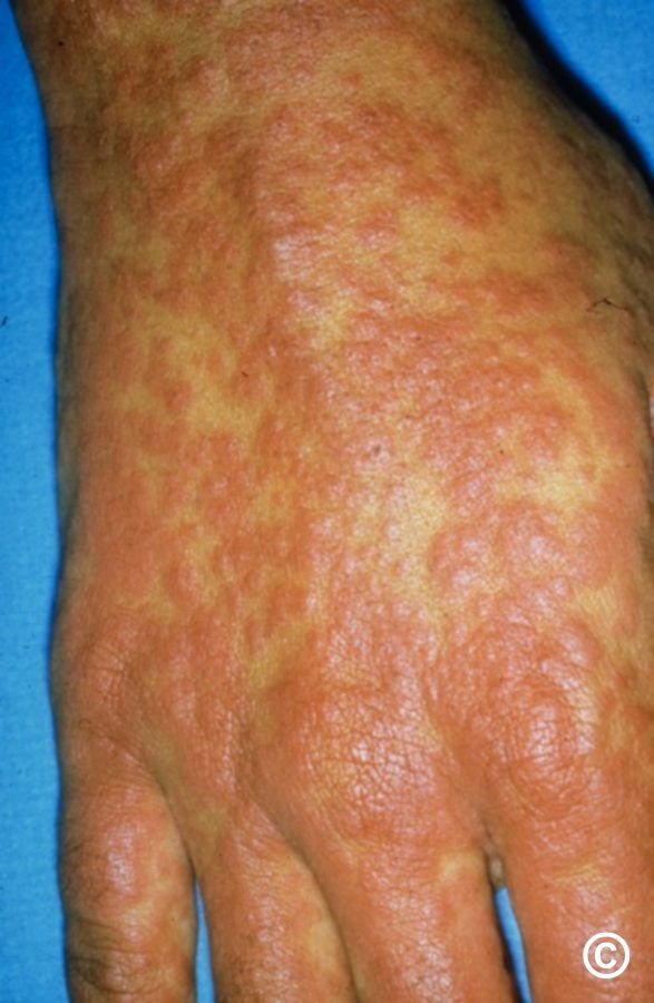 Drug rashes: mild to moderate