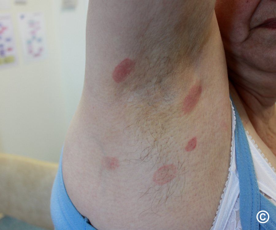 Drug rashes: mild to moderate