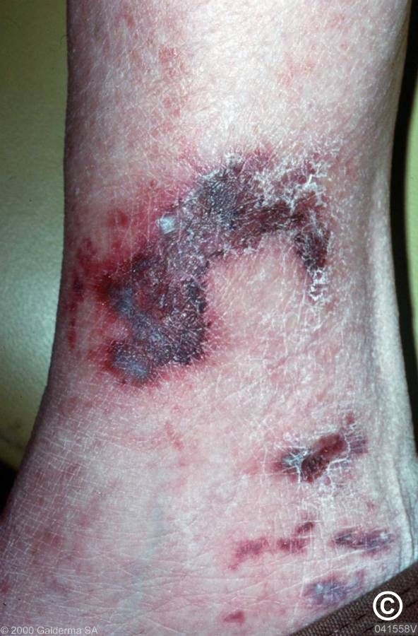 Sores On Body From Drugs