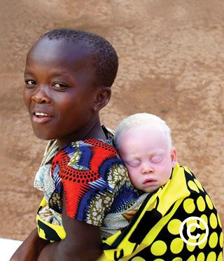 Oculocutaneous albinism