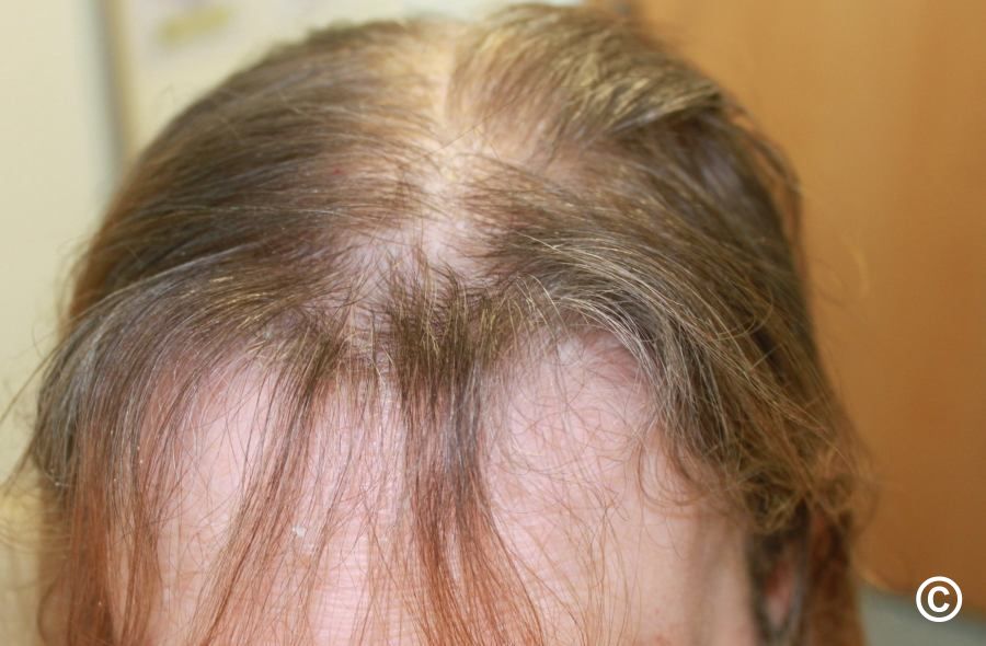 Alopecia