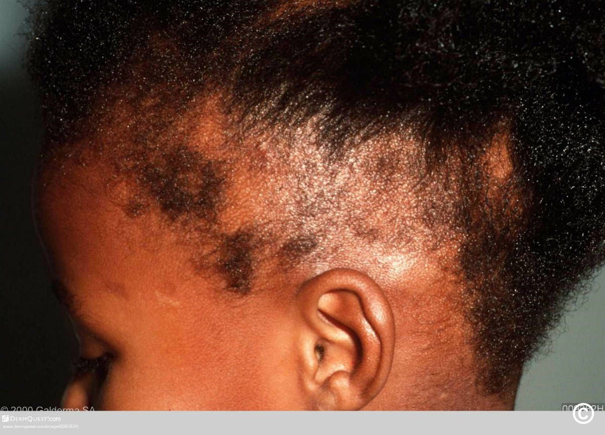 Alopecia In Children