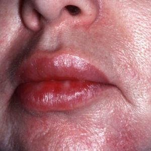 Angioedema