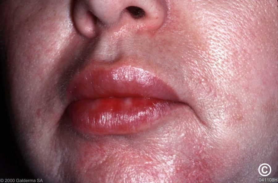 Angioedema