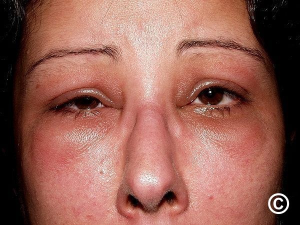 Angioedema Eyes
