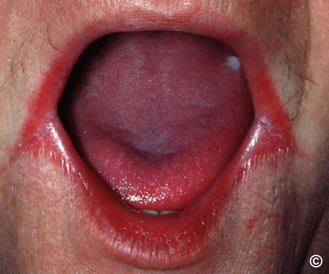 Angular cheilitis nhs store