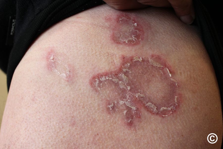 Erythema Annulare Centrifugum Histology
