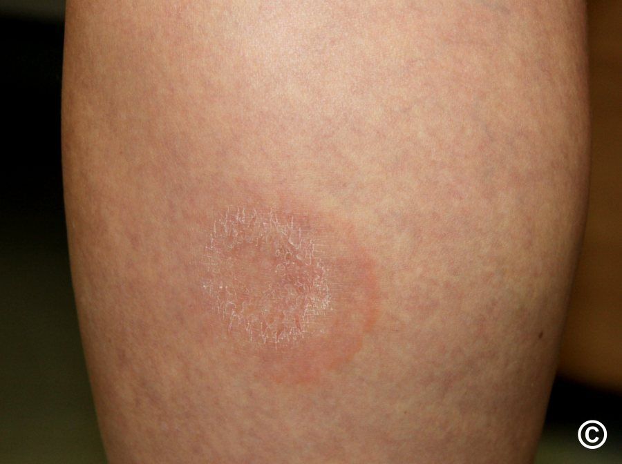 Erythema Annulare Centrifugum Thigh Erythema Annulare Centrifugum