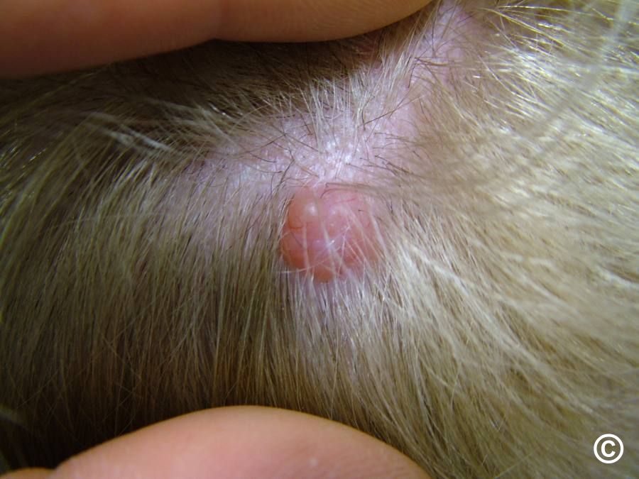 Cylindroma Treatment