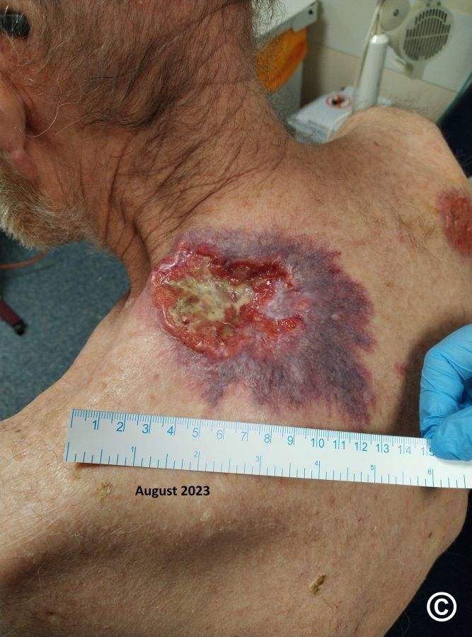 Basal cell carcinoma
