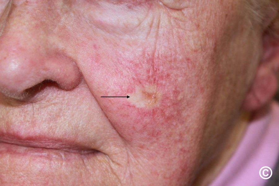 Basal Cell Carcinoma Nose