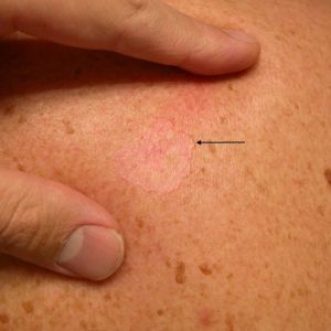 Basal cell carcinoma