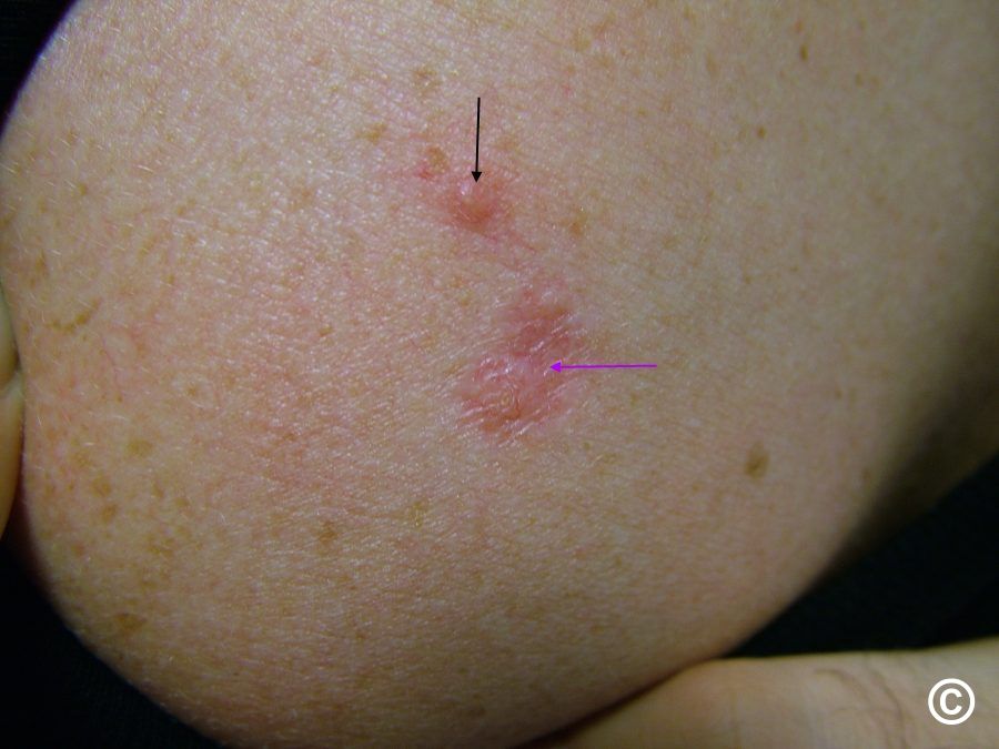 Basal Cell Carcinoma On Leg