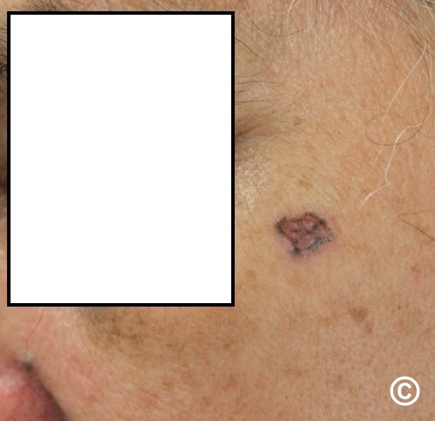 Pigmented BCC Of Left Neck Skin Cancer And Reconstructive, 44% OFF
