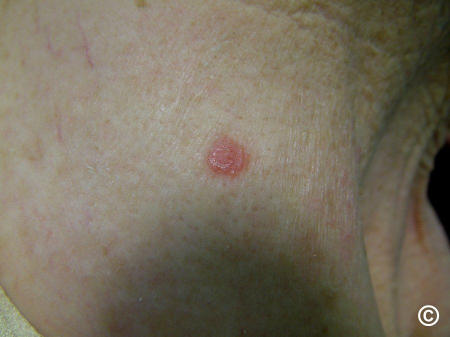 Superficial Basal Cell Carcinoma Early Stages