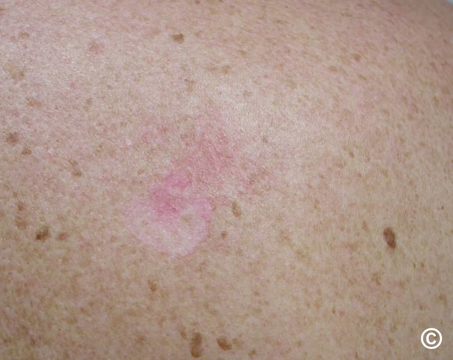 Superficial Basal Cell Carcinoma