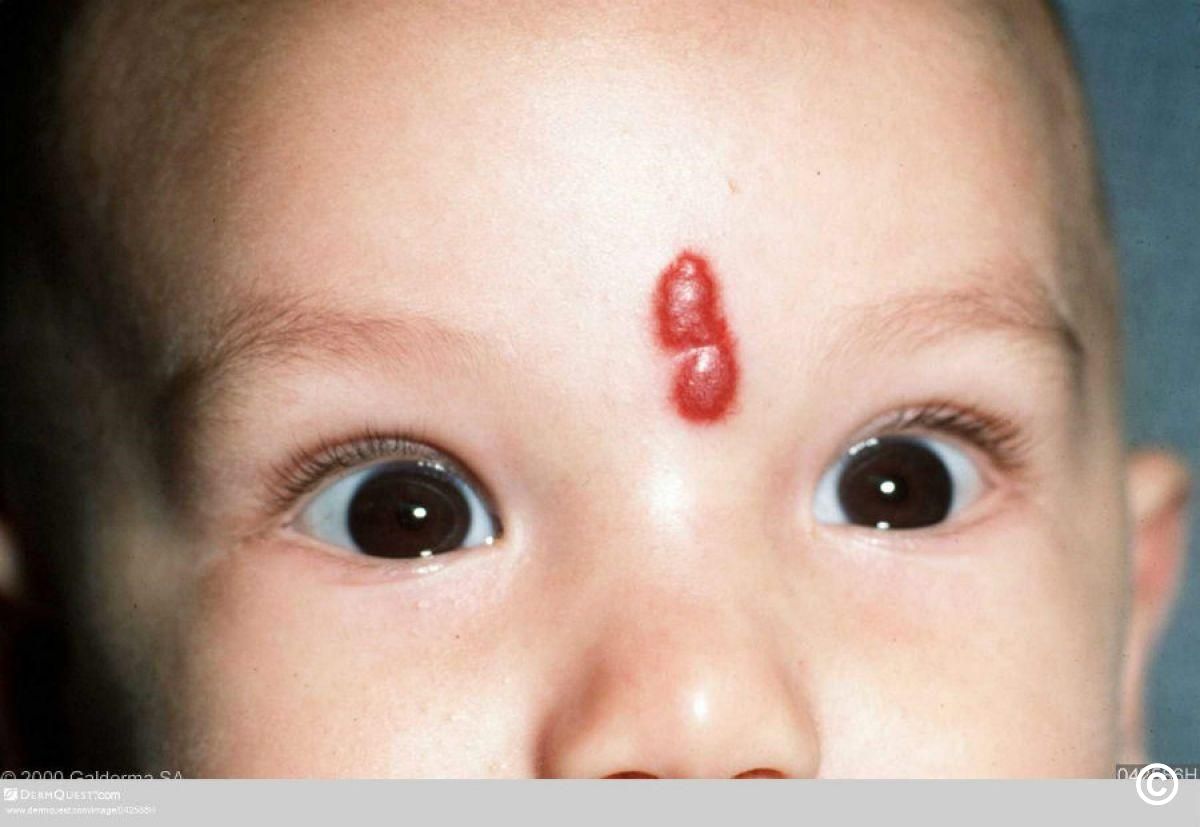 Birthmarks - an overview