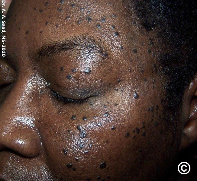 Dusky Skin Appearance