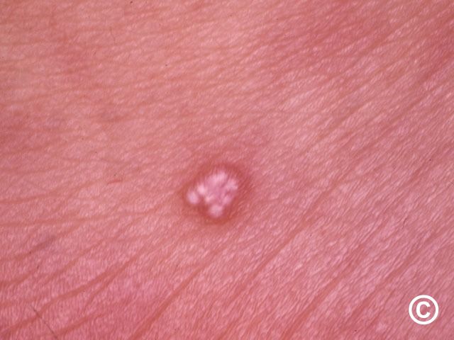 Calcium Spot On Nose