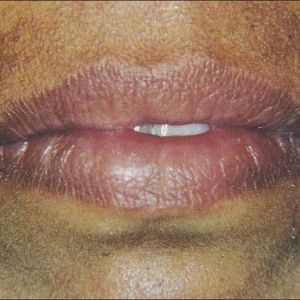 Candida Albicans Lips
