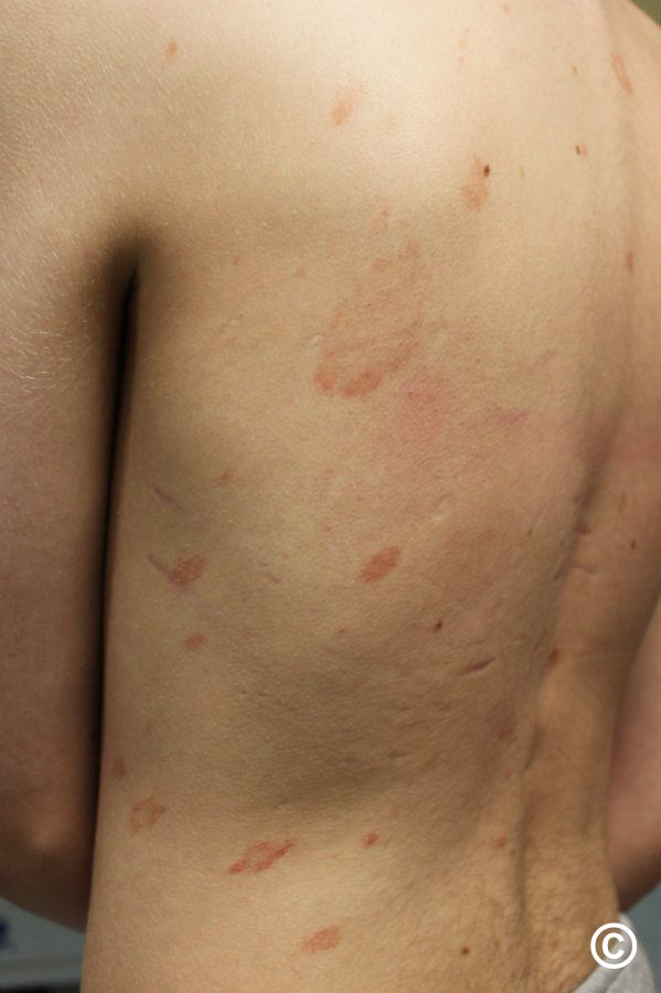 Exercise Induced Capillaritis