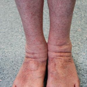 Pigmented purpuric dermatoses (syn. capillaritis)