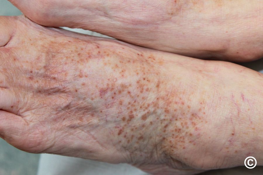 Pigmented purpuric dermatoses (syn. capillaritis)