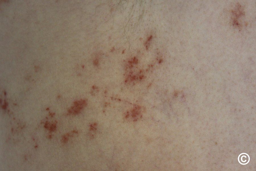 Pigmented purpuric dermatoses (syn. capillaritis)