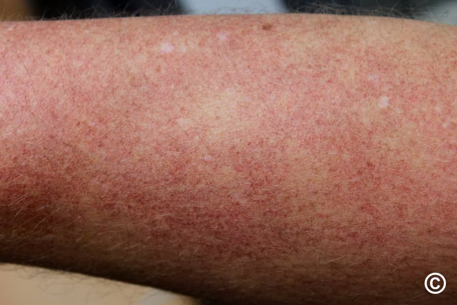 Exercise Induced Capillaritis