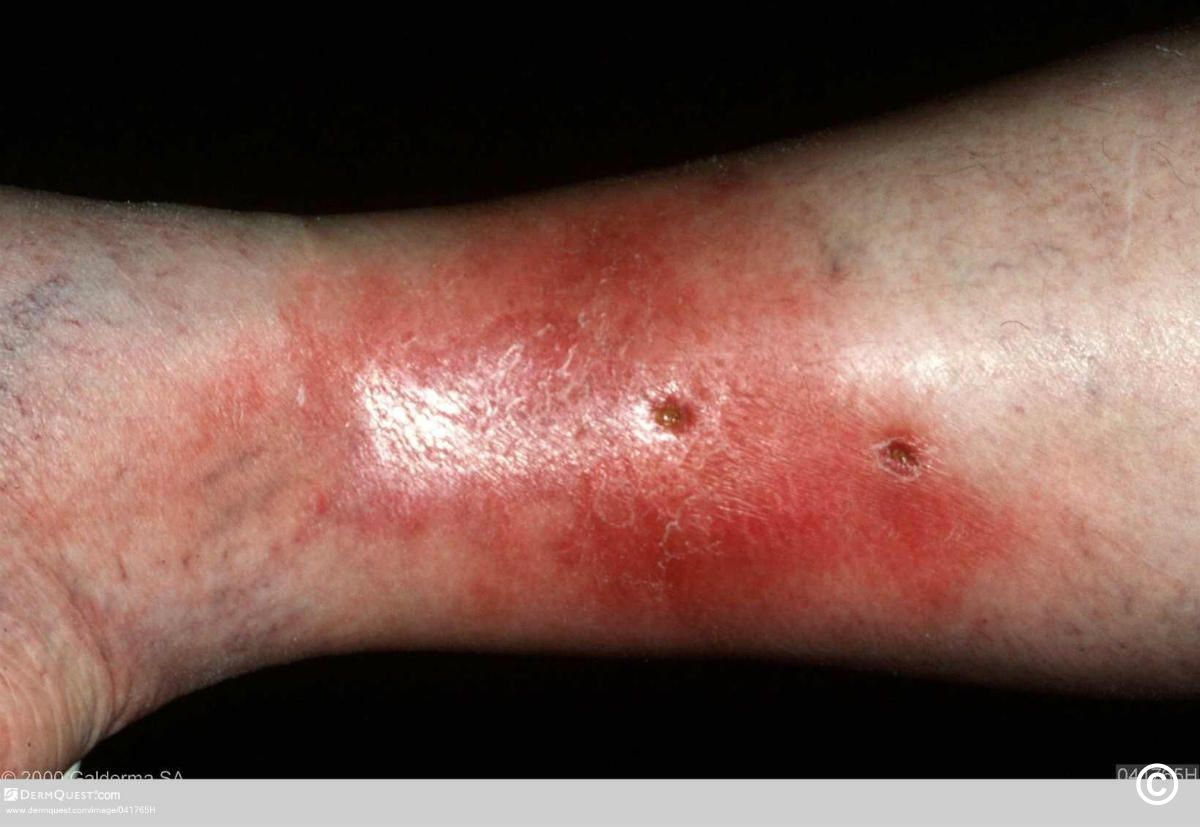 Cellulitis Nice Cks Diagnosis And Management Of Lower Limb Cellulitis