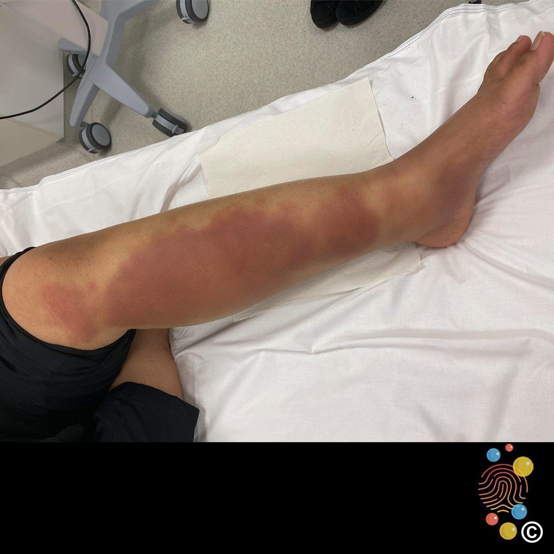 Cellulitis, erysipelas and necrotising fasciitis