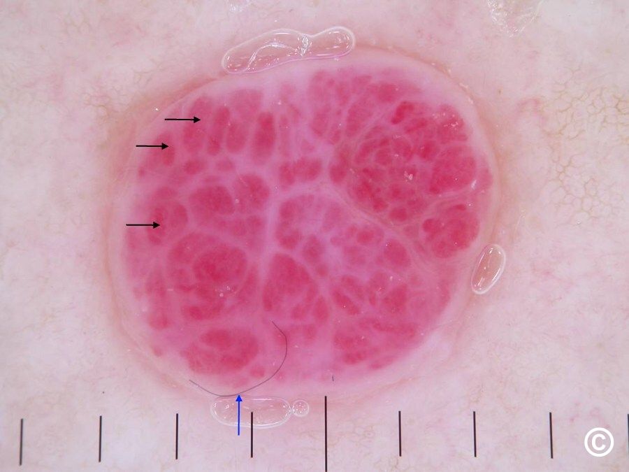 Cherry Hemangioma Nose