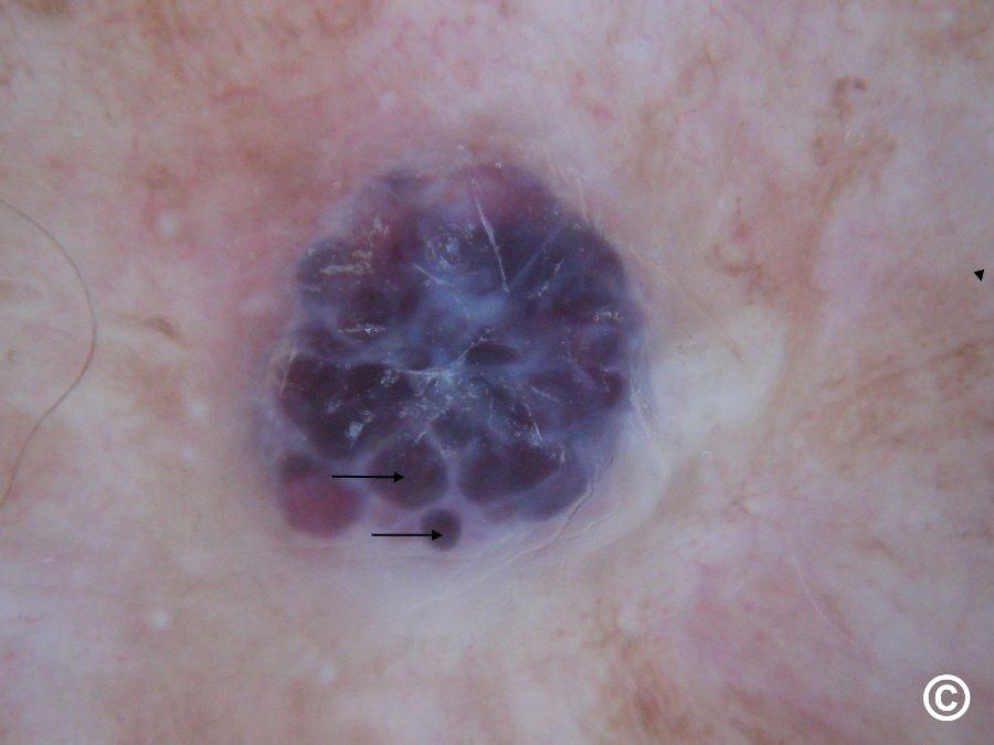Angioma