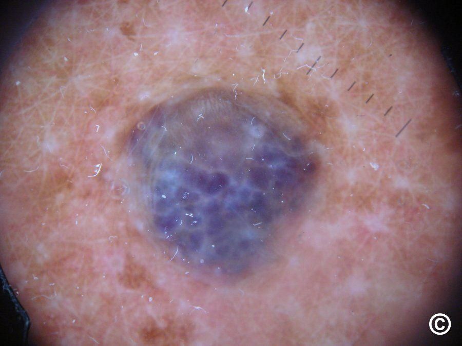Angioma