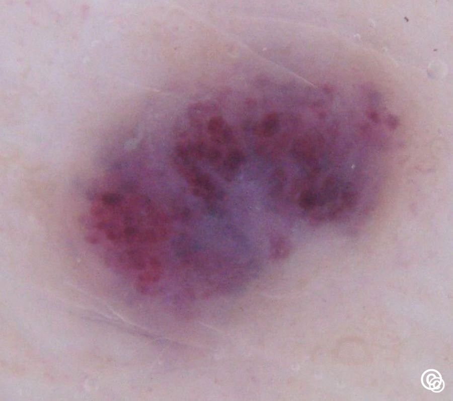 Angioma