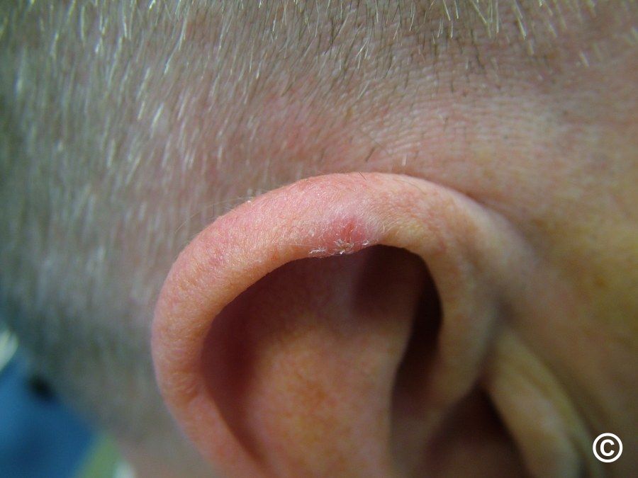 Chondrodermatitis Nodularis Helicis Histology