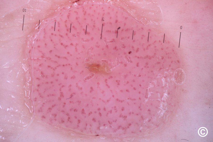 Clear cell acanthoma of Degos
