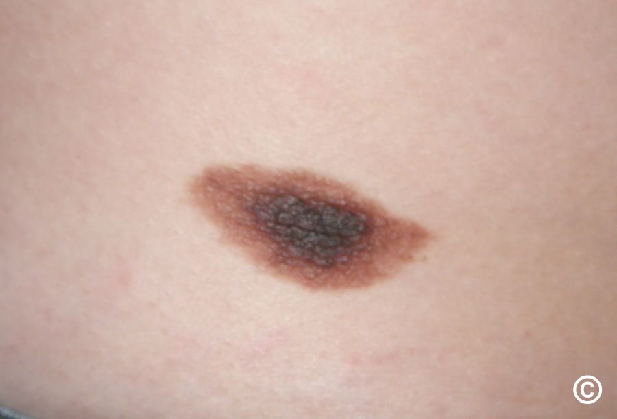 Congenital Nevus Melanoma