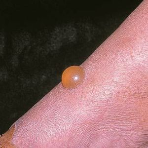dermal hypersensitivity reaction