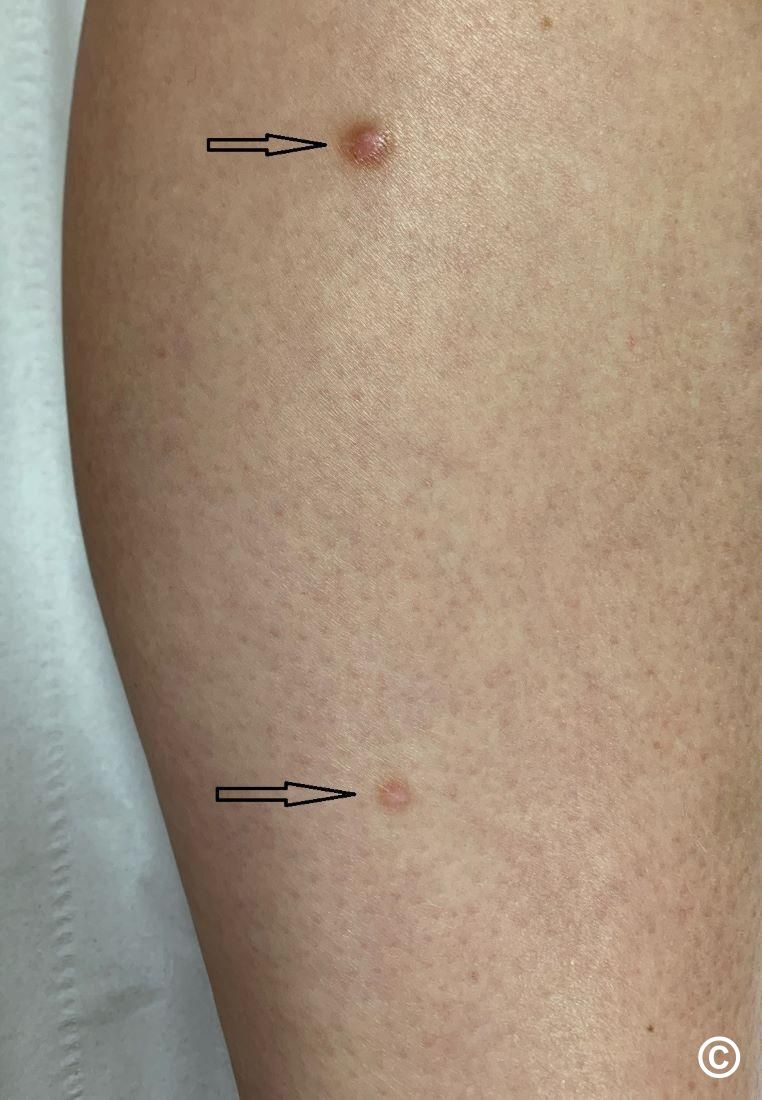 Dermatofibroma Dermatofibroma | Plastic Surgery Key