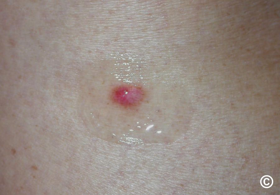 Cicatriz De Dermatofibroma Dermatofibroma, Histiocytoma