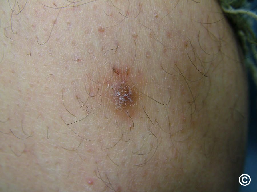 Dermatofibroma Bad Is Your Mole Cancerous? Detecting Skin Cancer With