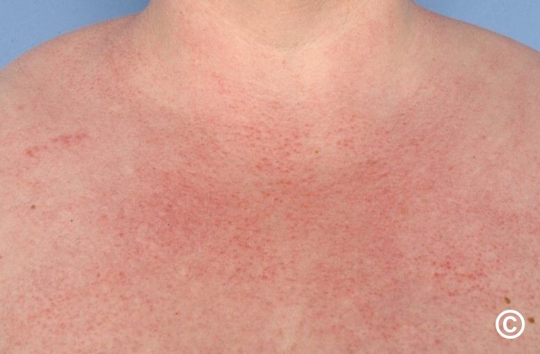 Dermatomyositis Chest