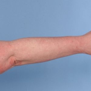 Myositis Skin Rash